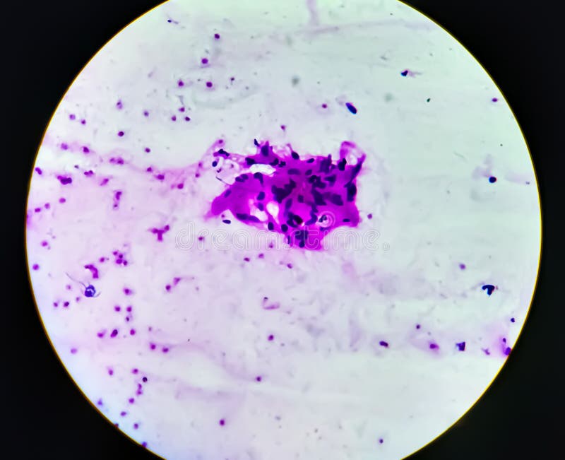 CT Guided FNA Form Left Lung Mass Microscopic 40x Objective View. Stock ...