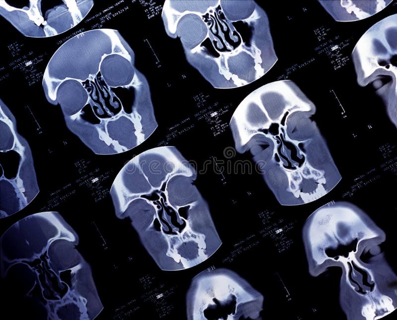 Brain CT with Scout stock image. Image of heads, medical - 6898519