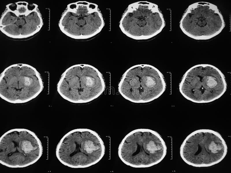 CT-hersenen stock foto. Image of verwonding, wetenschap - 106140562