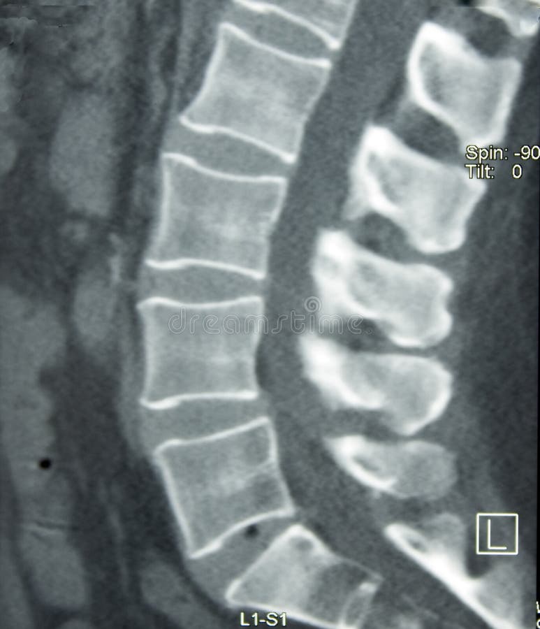 CT of Lumbar Spine stock photo. Image of bones, fracture - 9982766