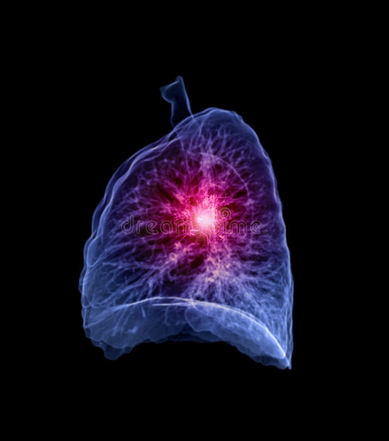 Lateral Lung Auscultation Sites Stock Vector - Illustration of medicine ...