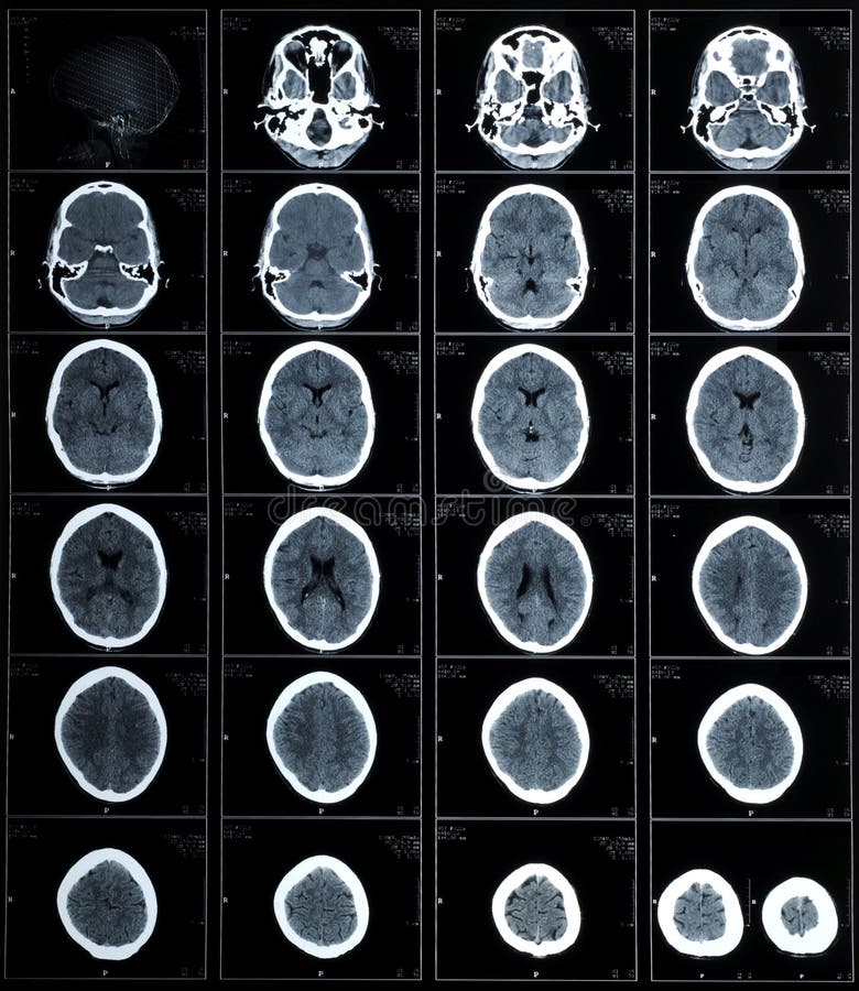 CT photo of human brain stock image. Image of diagnostic - 18643015