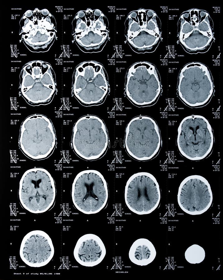 Brain CT Scan stock image. Image of ishemia, monitor - 23851097