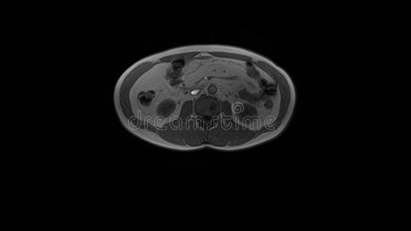 CT Scan of the Abdomen. Computed Tomography of the Gastrointestinal ...