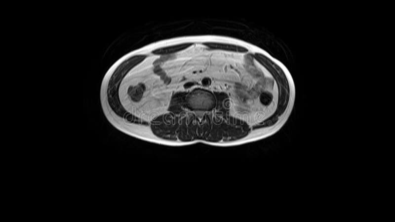 CT Scan of the Abdomen. Computed Tomography of the Gastrointestinal ...