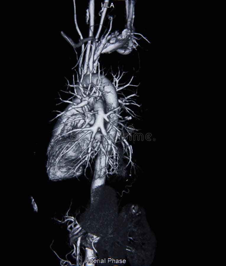 Ct Scan Angiogram (take Photo from Film X-ray) Stock Image - Image of ...
