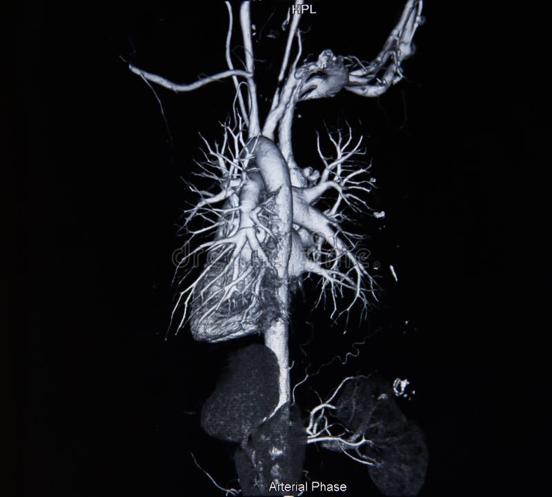 Ct Scan Angiogram (take Photo from Film X-ray) Stock Photo - Image of ...