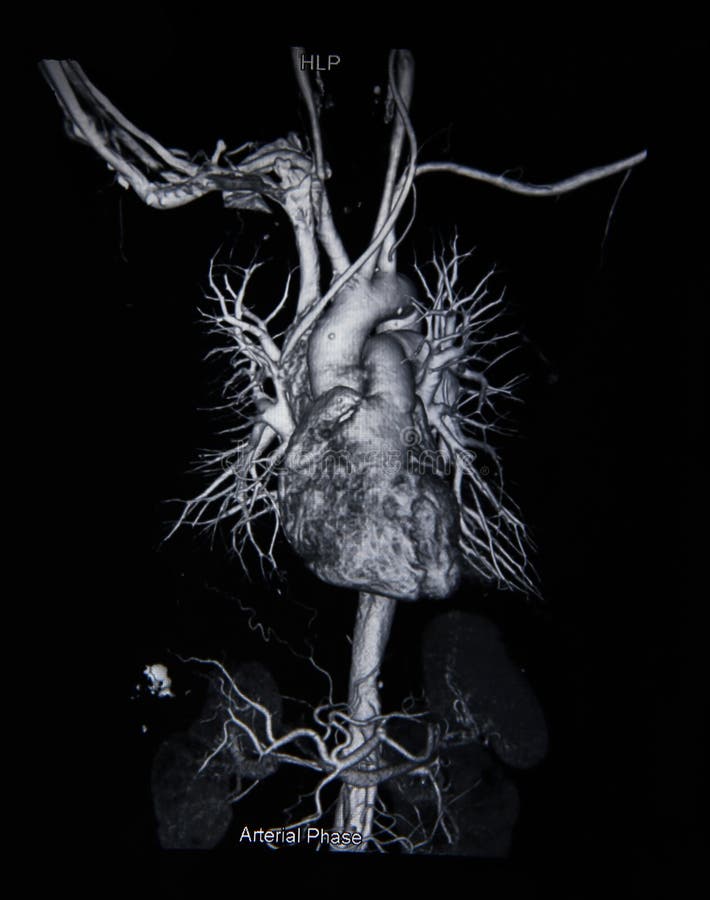 Ct Scan Angiogram (take Photo from Film X-ray) Stock Photo - Image of ...