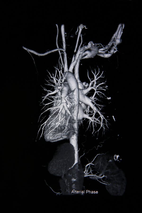 Ct Scan Angiogram (take Photo from Film X-ray) Stock Photo - Image of ...