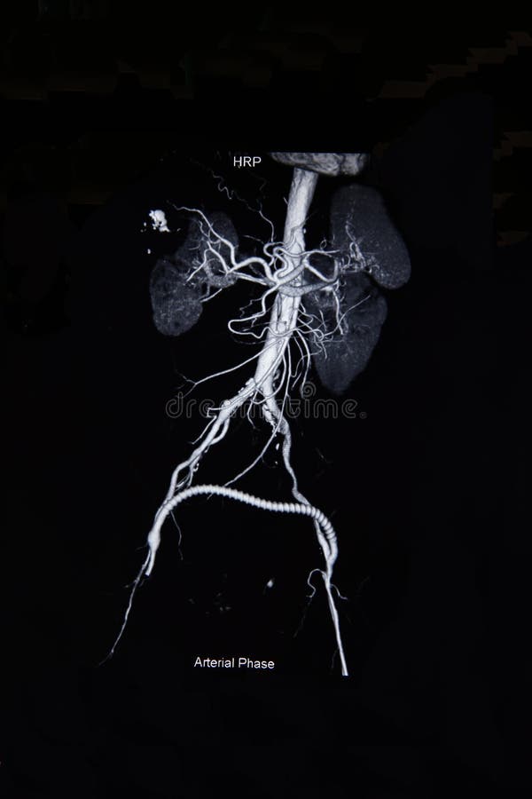 Ct Scan Angiogram (take Photo from Film X-ray) Stock Image - Image of ...