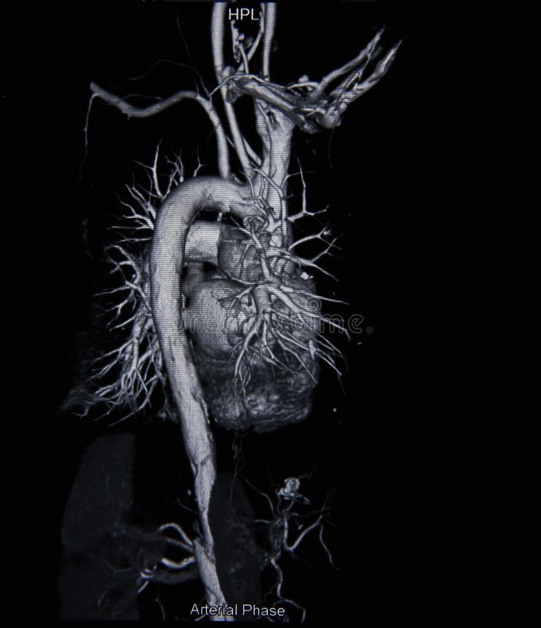 Ct Scan Angiogram (take Photo from Film X-ray) Stock Image - Image of ...