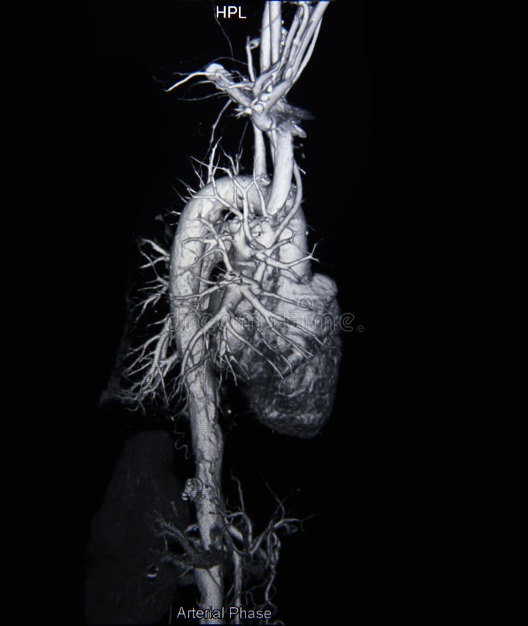 CT Scan Angiogram Show Dextrocardia the Congenital Heart Disease Stock ...