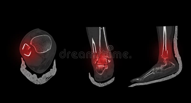 Ct Scan Ankle And Foot Or Computed Tomography Of Ankle Joint And Foot 3d Volume Rendering Image