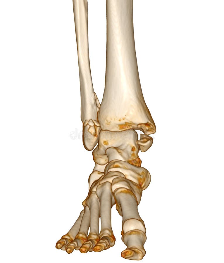CT Scan Ankle and Foot or Computed Tomography of Ankle Joint and Foot ...