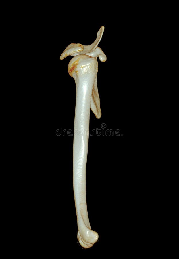 CT scan of elbow joint stock illustration. Illustration of diagnosis ...
