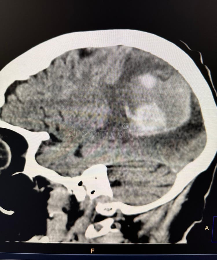 CT Scan of the Brain with Abnormality Stock Photo - Image of gray ...