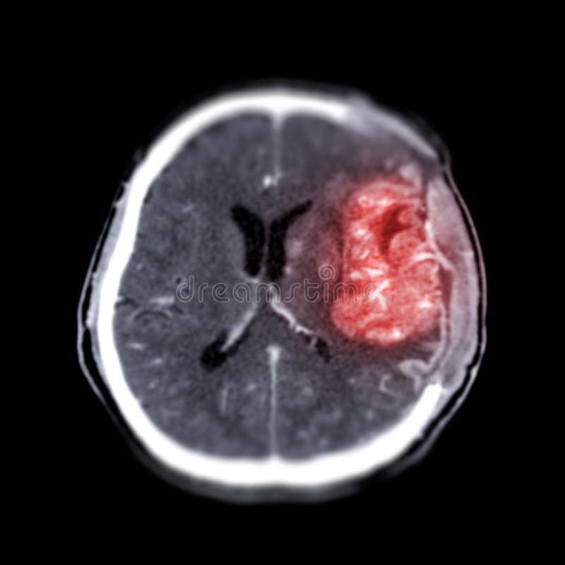 CT Scan of the Brain Axial View Post Operative Brain Tumor Stock Photo ...