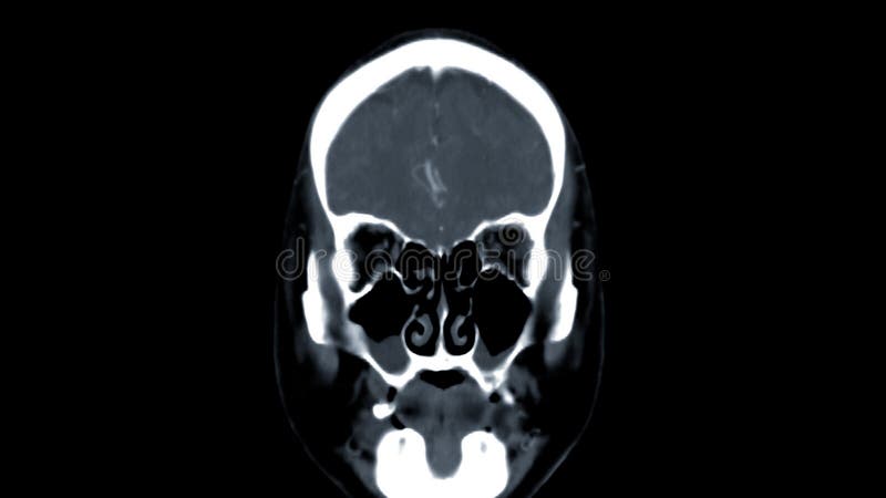 CT Scan of the Brain Coronal View for Diagnosis Brain Tumor,stroke ...