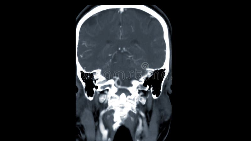 CT Scan of the Brain Coronal View for Diagnosis Brain Tumor,stroke ...