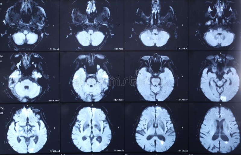 CT scan brain stock image. Image of report, result, neurons - 38687217
