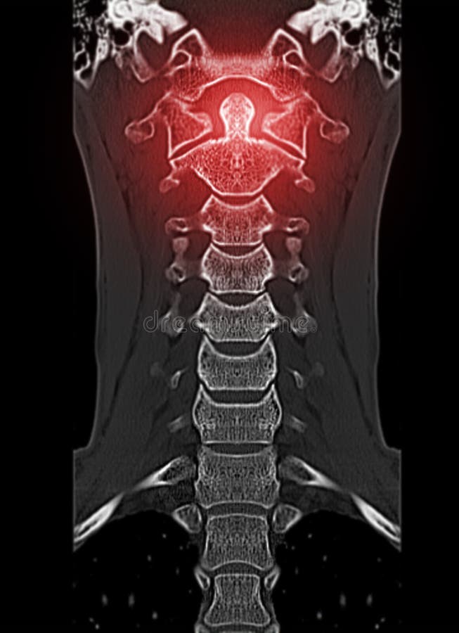 CT Scan of C-Spine or Cervical Spine Stock Illustration - Illustration ... CT Scan of C-Spine or Cervical Spine Stock Illustration - Illustration ...