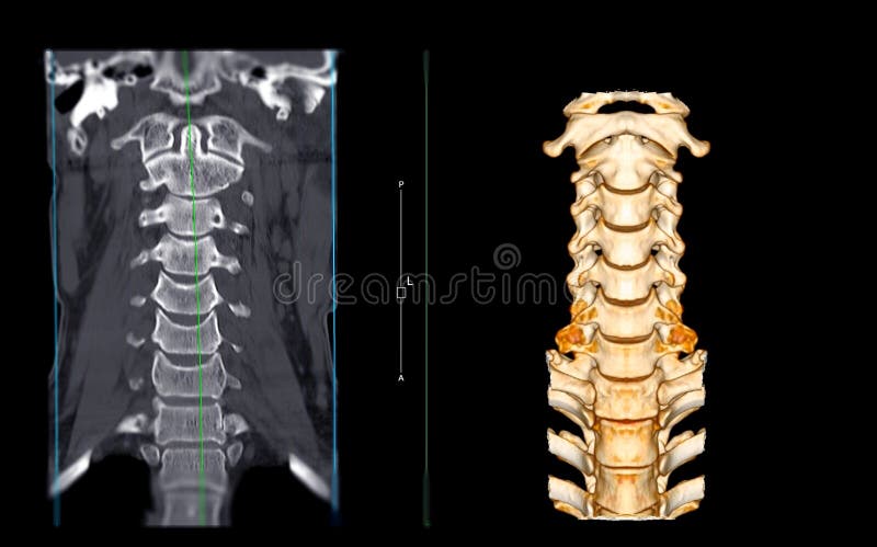 CT Scan of C-Spine or Cervical Spine Stock Illustration - Illustration ... CT Scan of C-Spine or Cervical Spine Stock Illustration - Illustration ...