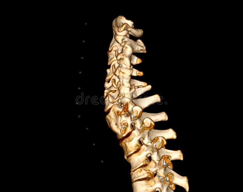 Ct Scan Of C Spine Or Cervical Spine Stock Illustration Illustration Of Tension Disease