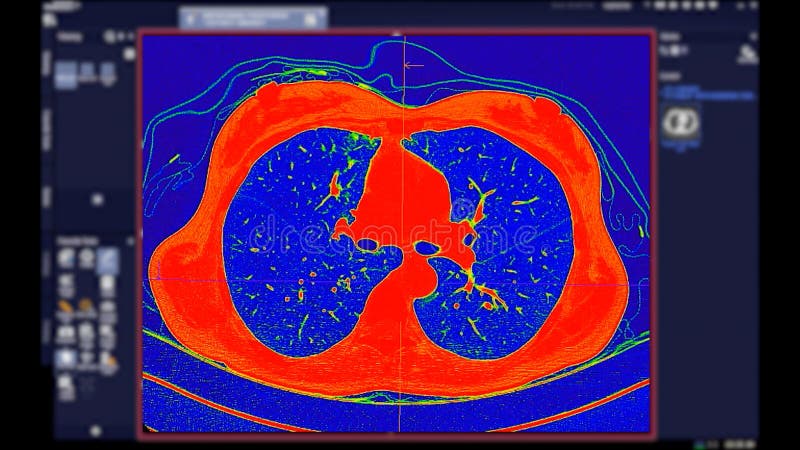 Ct Scan Of Chest Axial View In Color Mode For Diagnostic Pulmonary