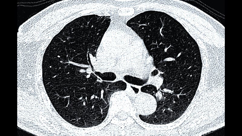 CT Scan of Chest or Lung Axial View for Screening Lung Nodules Stock ...