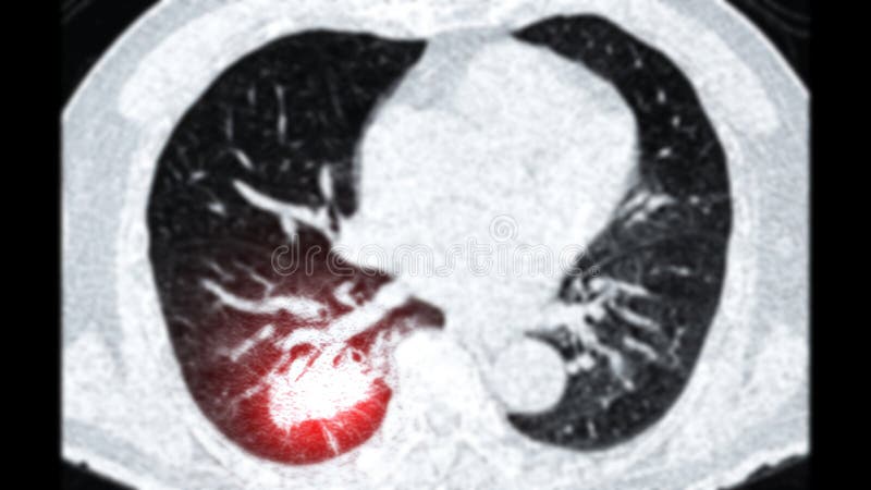 Ct Scan Of Chest Or Lung Axial Viewshowing Lung Cancer Lung Cancer