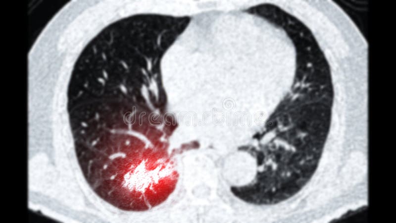 CT Scan of Chest or Lung Axial Viewshowing Lung Cancer Lung Cancer ...