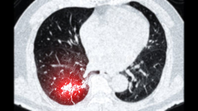 CT Scan of Chest or Lung Axial Viewshowing Lung Cancer Lung Cancer ...