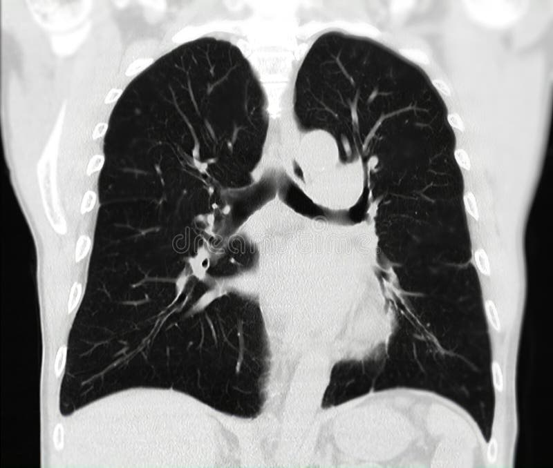 CT Scan of Chest or Lung for Screening Lung Nodules and Lung Cancer ...