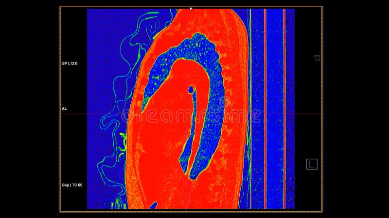 Ct Scan Of Chest Sagittal View In Color Mode For Diagnostic Pulmonary Embolism Pe Lung