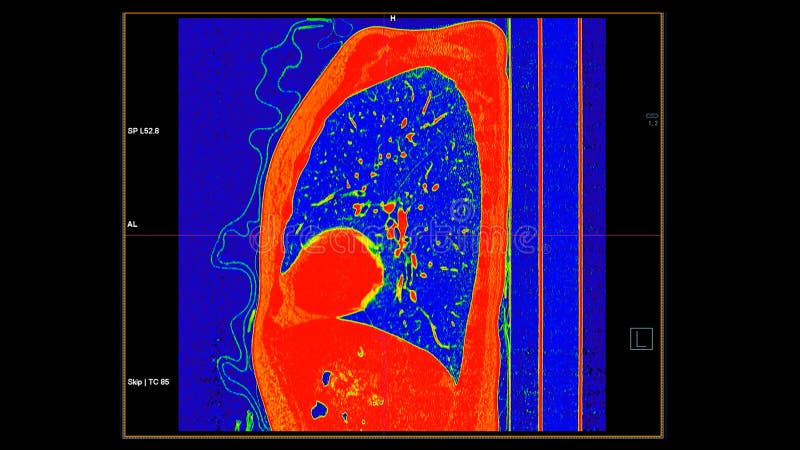 Ct Scan Of Chest Sagittal View In Color Mode For Diagnostic Pulmonary Embolism Pe Lung