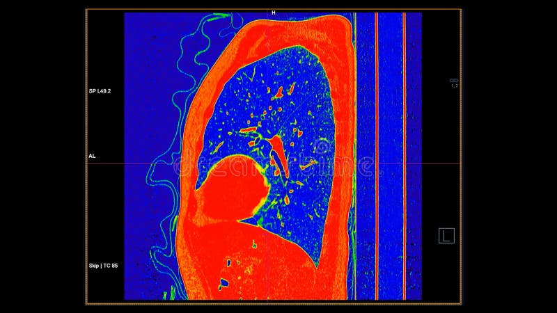 Ct Scan Of Chest Sagittal View In Color Mode For Diagnostic Pulmonary Embolism Pe Lung