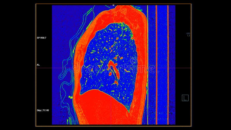 Ct Scan Of Chest Sagittal View In Color Mode For Diagnostic Pulmonary Embolism Pe Lung