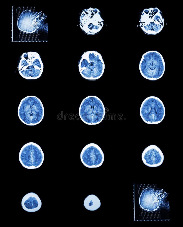 CT Scan & X28; Computed Tomography & X29; with 3D Graphic Show Normal ...