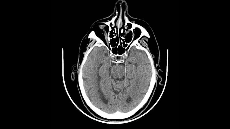 CT Scan. Computed Tomography. Skull Stock Video - Video of medicine ...
