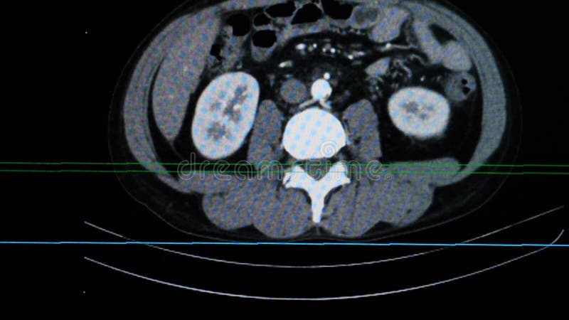 CT Scan of the Abdomen. Computed Tomography of the Gastrointestinal ...