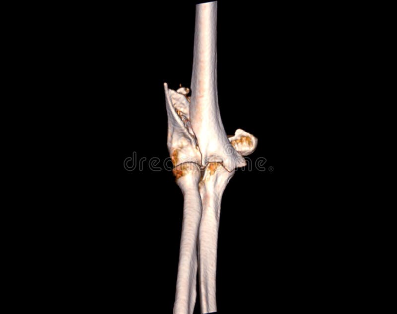 Fracture Elbow Stock Illustrations – 592 Fracture Elbow Stock ...