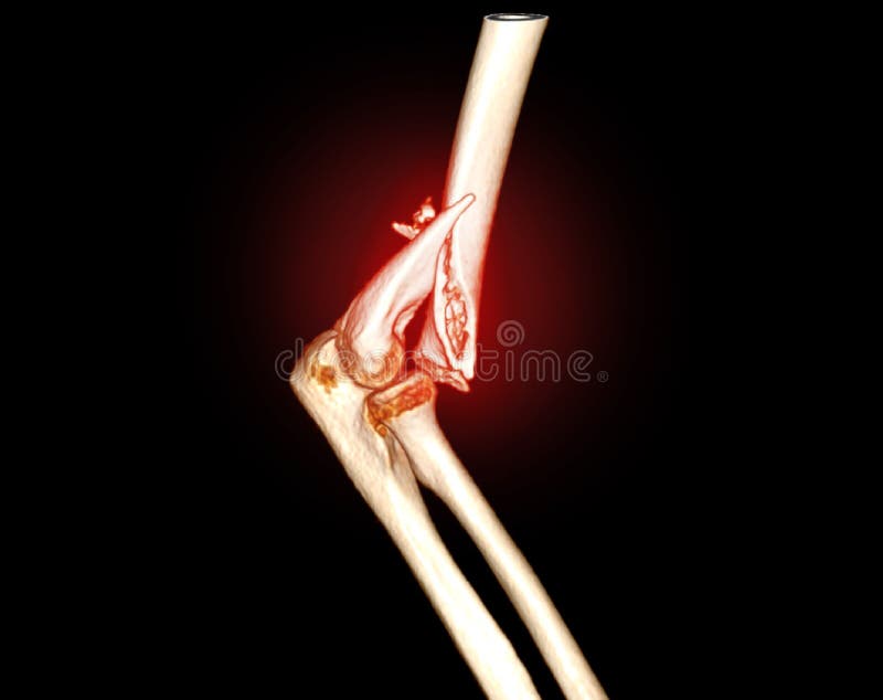 Fracture Elbow Stock Illustrations – 592 Fracture Elbow Stock ...