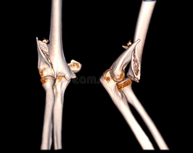 CT scan of elbow joint stock illustration. Illustration of panicking ...