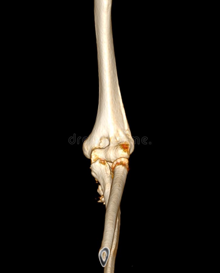 CT scan of elbow joint stock illustration. Illustration of examination ...