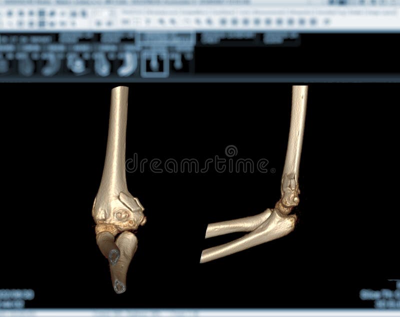 Fracture Elbow Stock Illustrations – 592 Fracture Elbow Stock ...