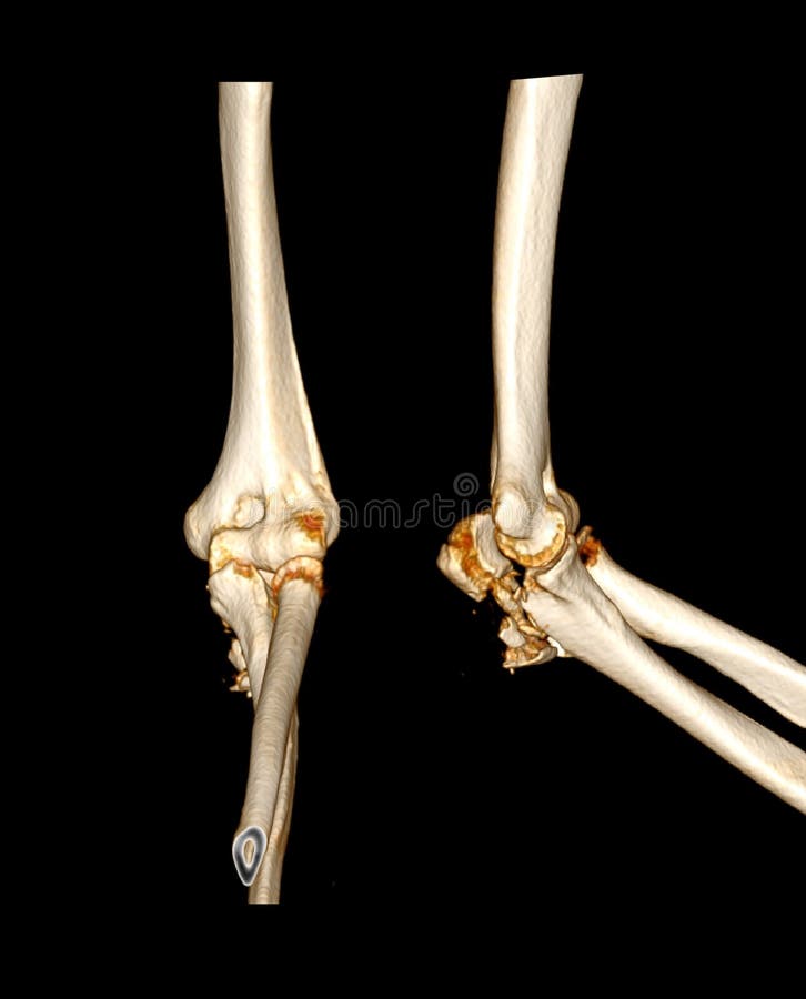 CT scan of elbow joint stock illustration. Illustration of structure ...