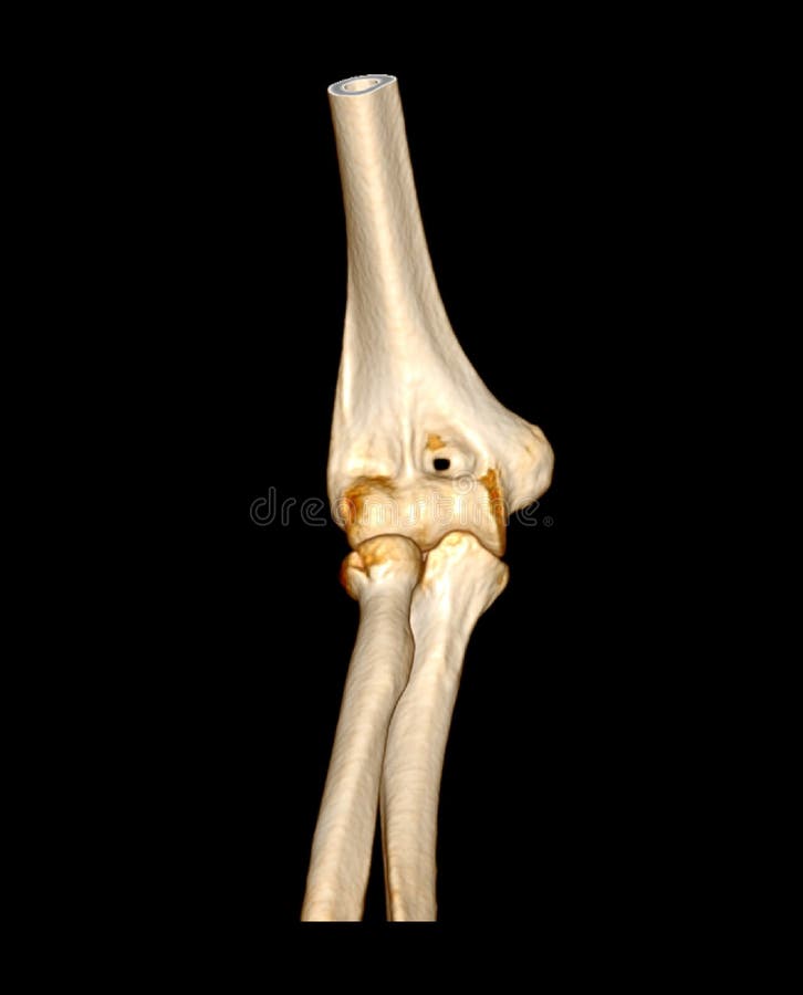 CT scan of elbow joint stock illustration. Illustration of panicking ...
