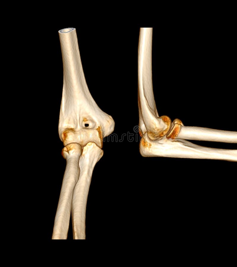 Ct Scan Of Elbow Joint Stock Illustration Illustration Of Diagnosis 255352616