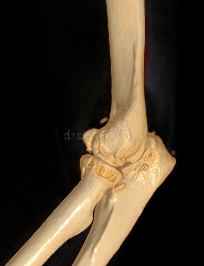 CT Scan of Elbow Joint 3d Rendering Stock Illustration - Illustration ...