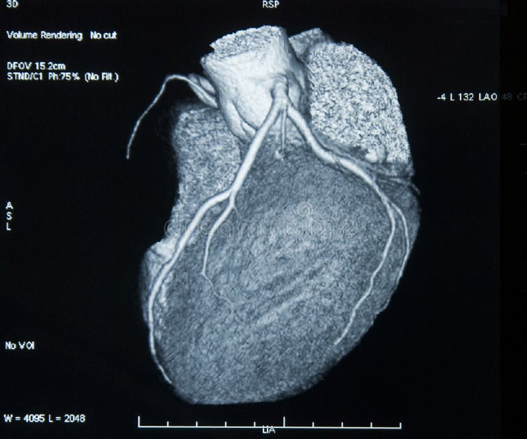 CT-Scan Heart stock photo. Image of negative, scan, heart - 17951270